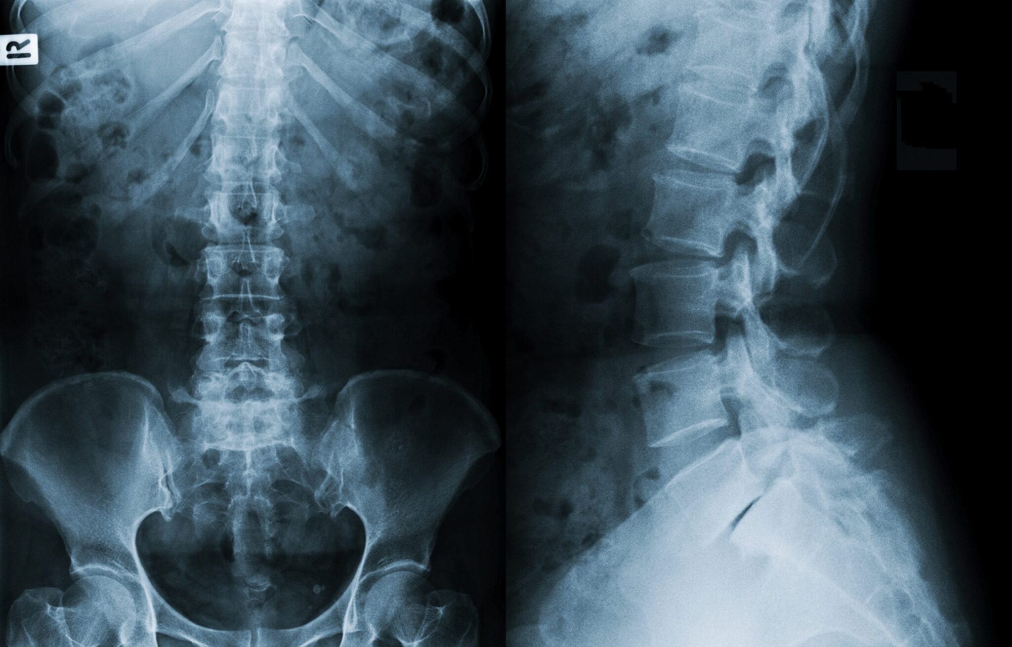 Spine Services & Procedures in Boardman | Southwoods Health